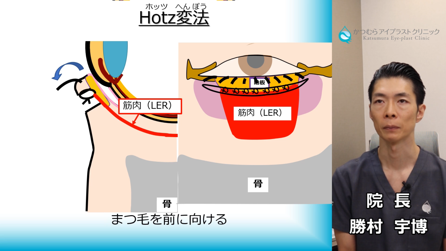 【60秒でわかる「逆さまつげ」】④ 治療方法｜かつむらアイプラストクリニック