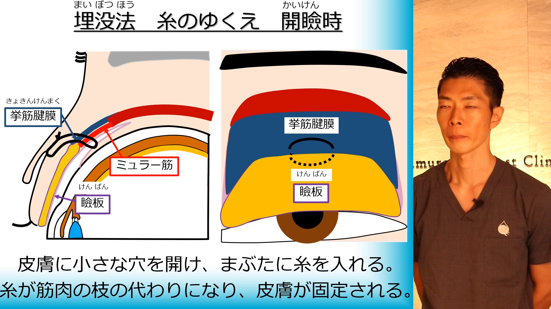 【30秒でわかる重瞼(二重)術】② 埋没法と切開法｜かつむらアイプラストクリニック