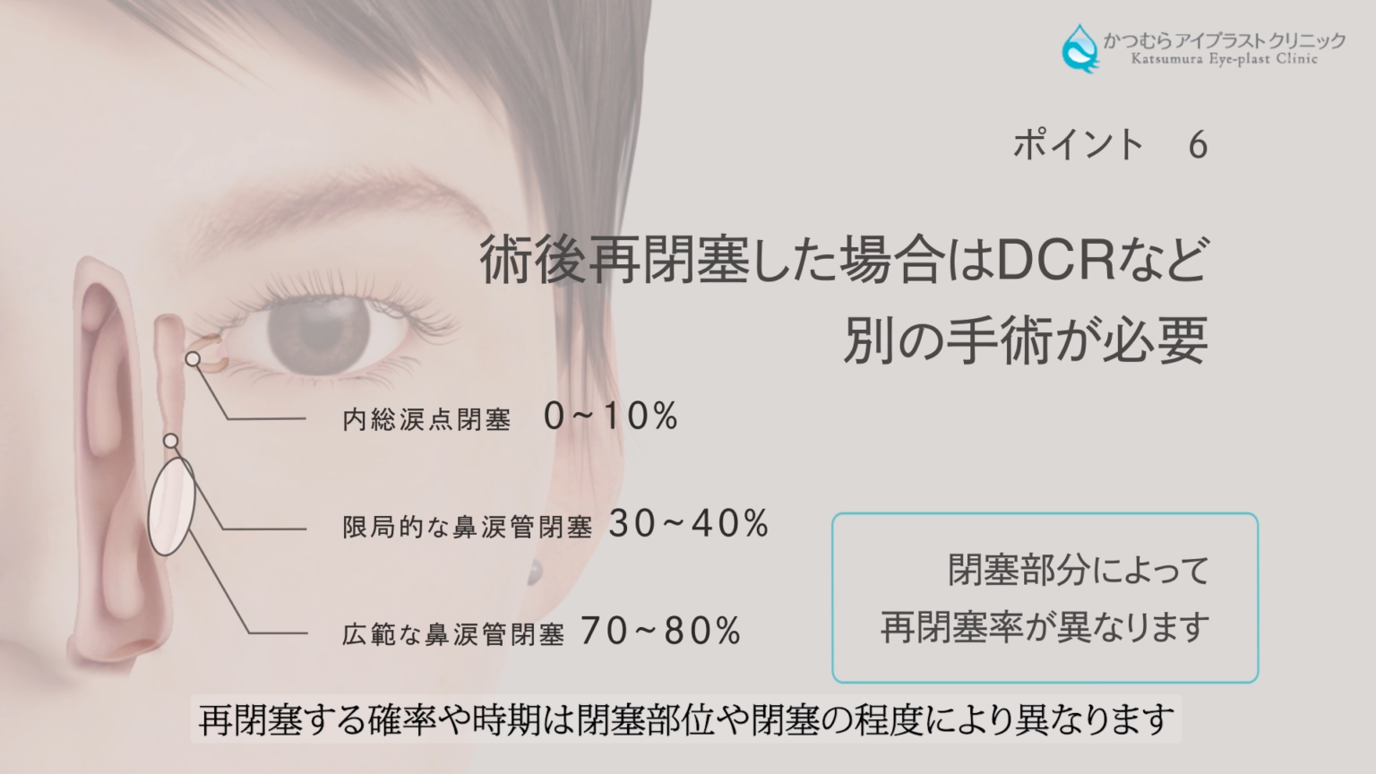 【涙管チューブ挿入術を受ける方に必ず伝える】術前後の6つのポイント｜かつむらアイプラストクリニック